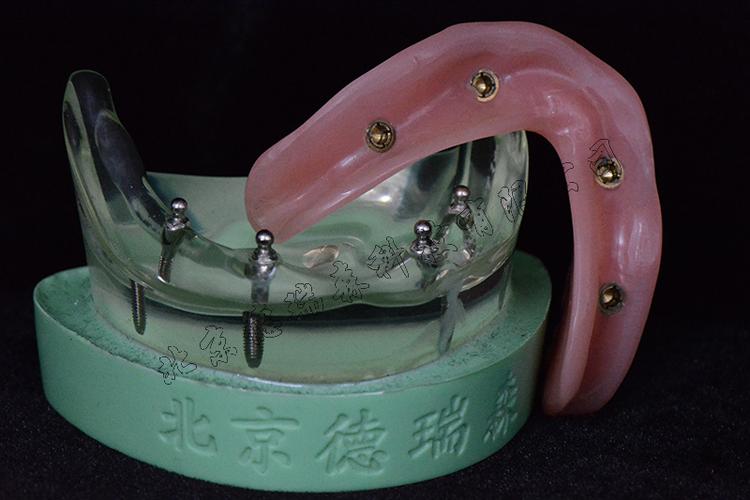 球帽式种植覆盖义齿：换上新笑容的魔术帽-侧美网